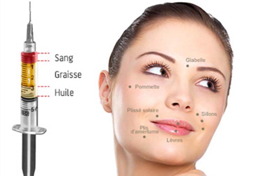 Lipofilling visage - Dr Anis Mallek